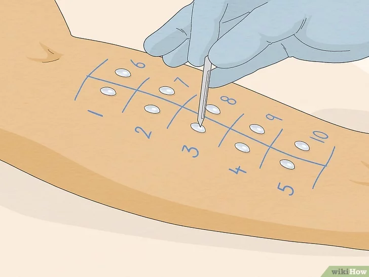 Prick tests | Docteur TOUDERT Pneumologue Tazmalt